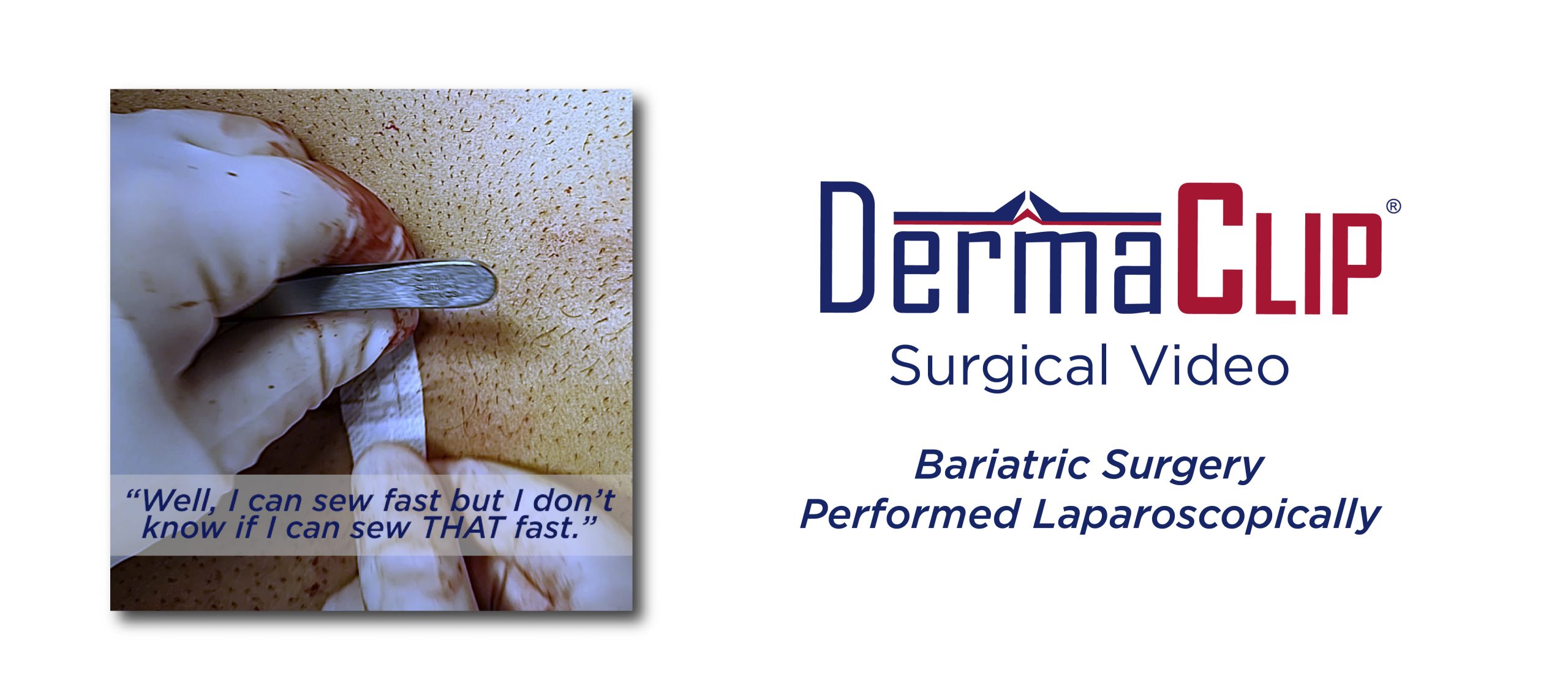 DermaClip Closure of Laparoscopic Bariatric Surgery - DermaClip