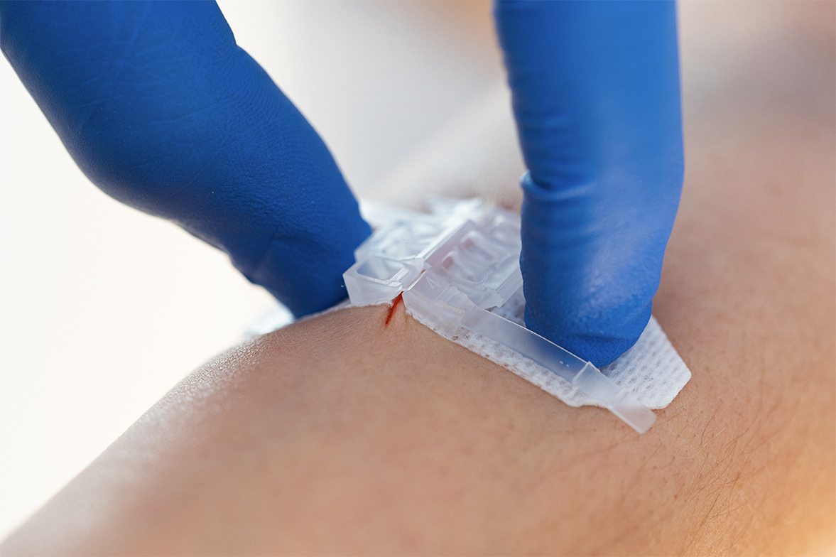 DermaClip skin closure devices areperfect for closing wounds